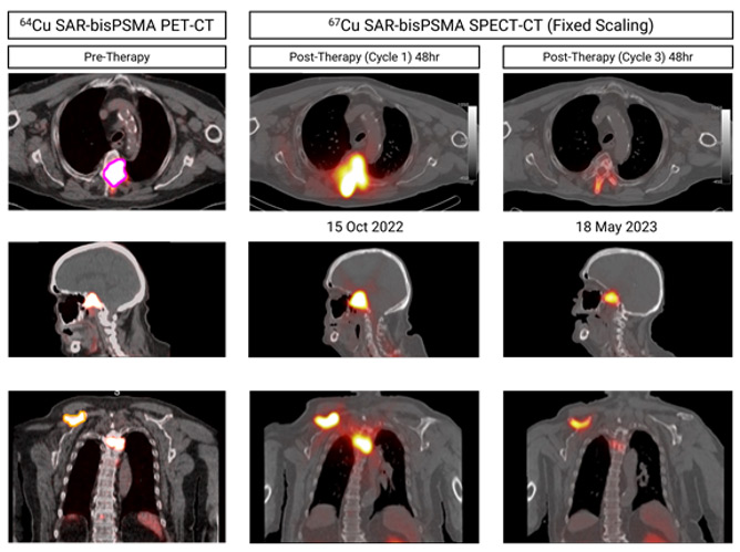 NorthStar Medical Radioisotopes Now Routinely Manufacturing High ...